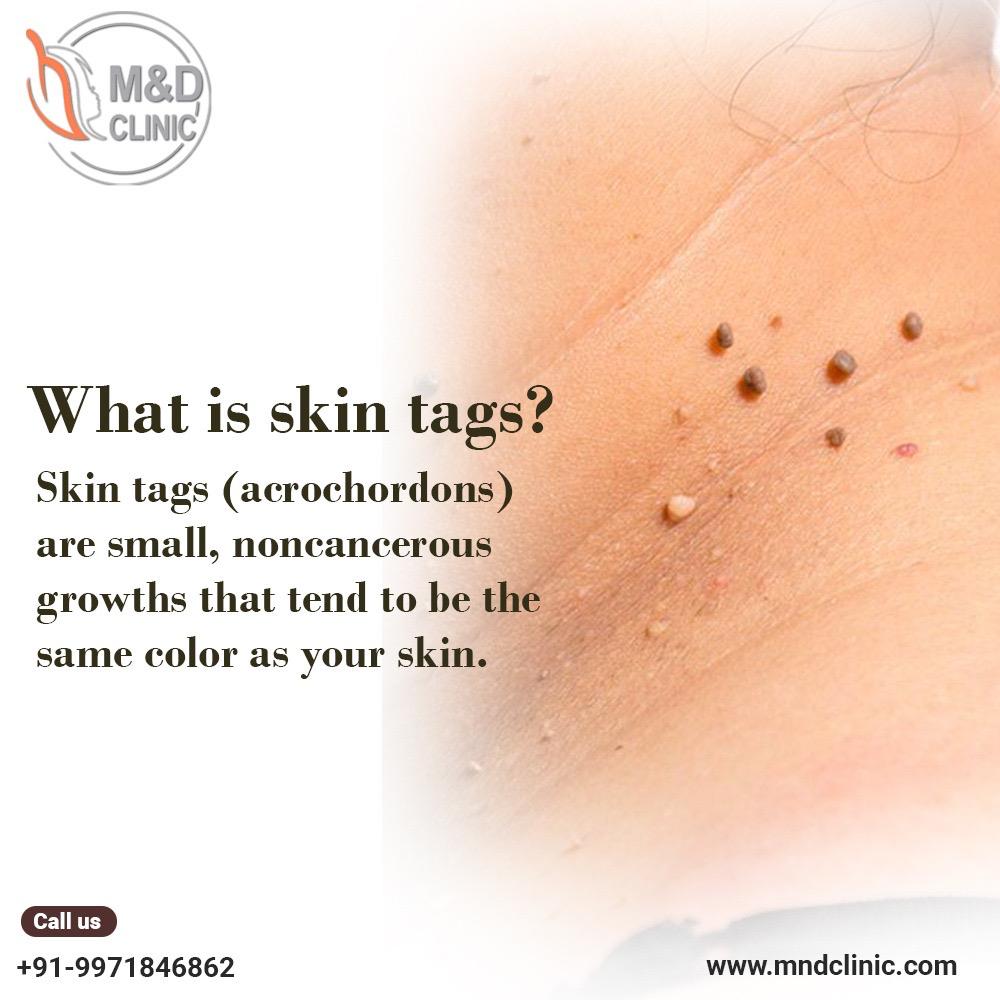 Skin Tags, Moles :: M & D Clinic